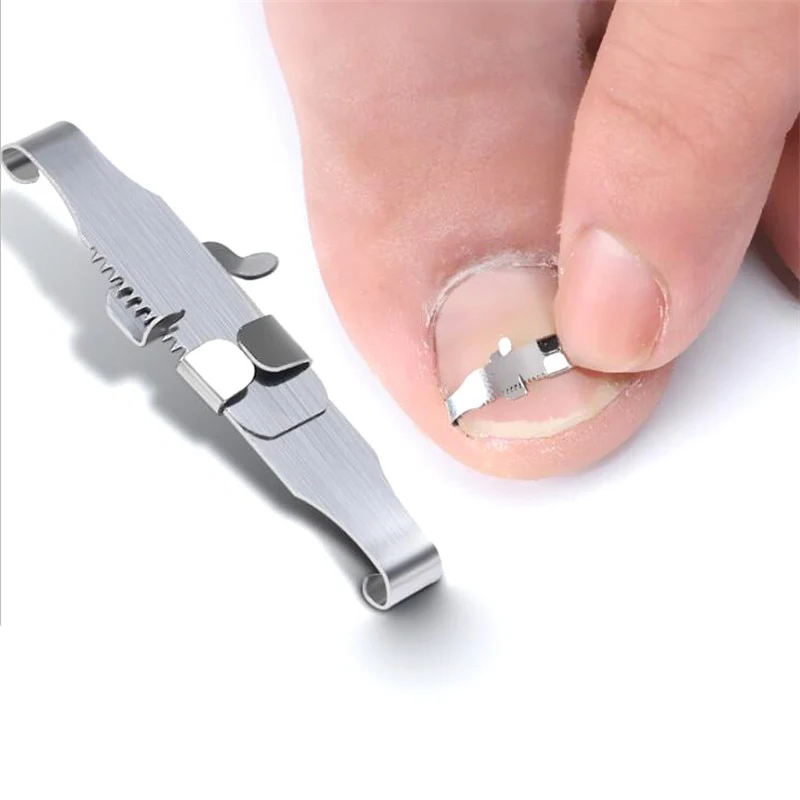 Ingrown toenail corrector Tools Health Product toenail correction Foot ...